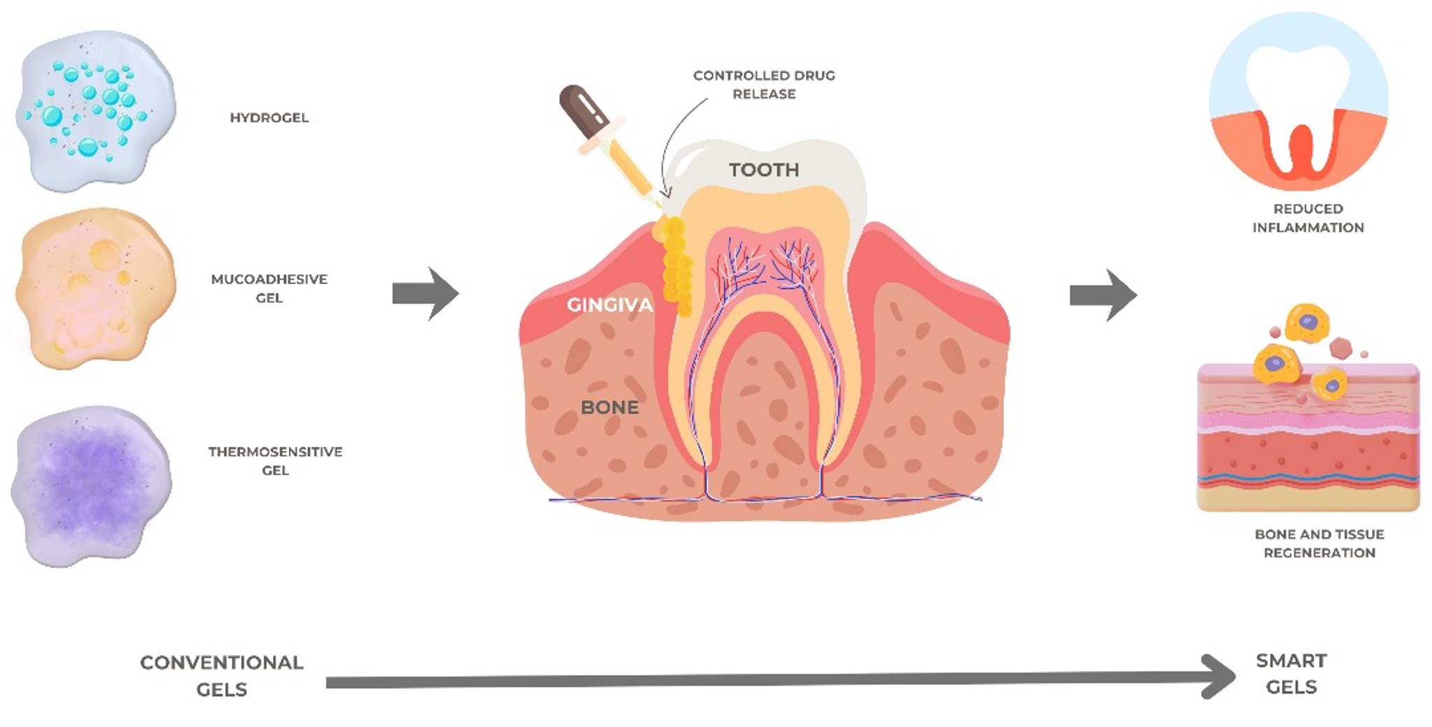 Gel Delivery Systems in Dental Medicine: From Controlled Release to ...
