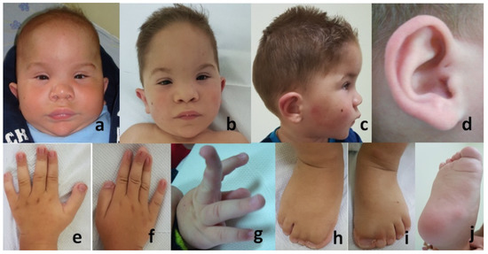 Greig Cephalopolysyndactyly Contiguous Gene Syndrome: Case Report and ...