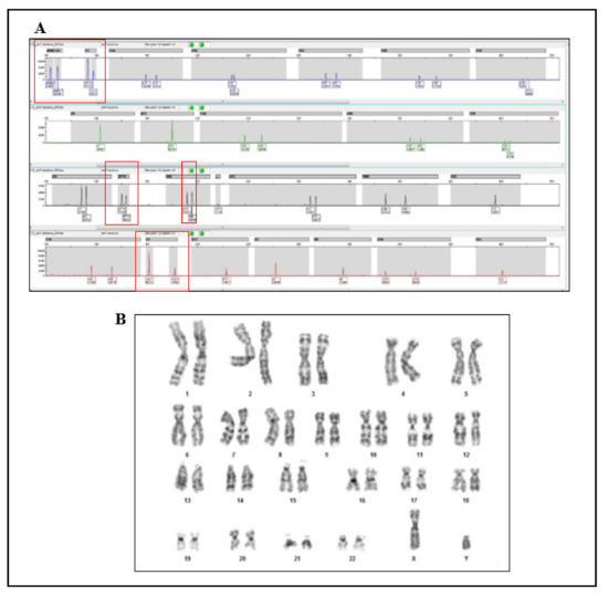 Detection of 46, XY Disorder of Sex Development (DSD) Based on Plasma ...
