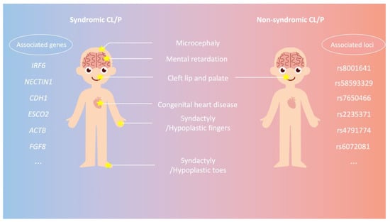 Genetic Inheritance Models of Non-Syndromic Cleft Lip with or without ...