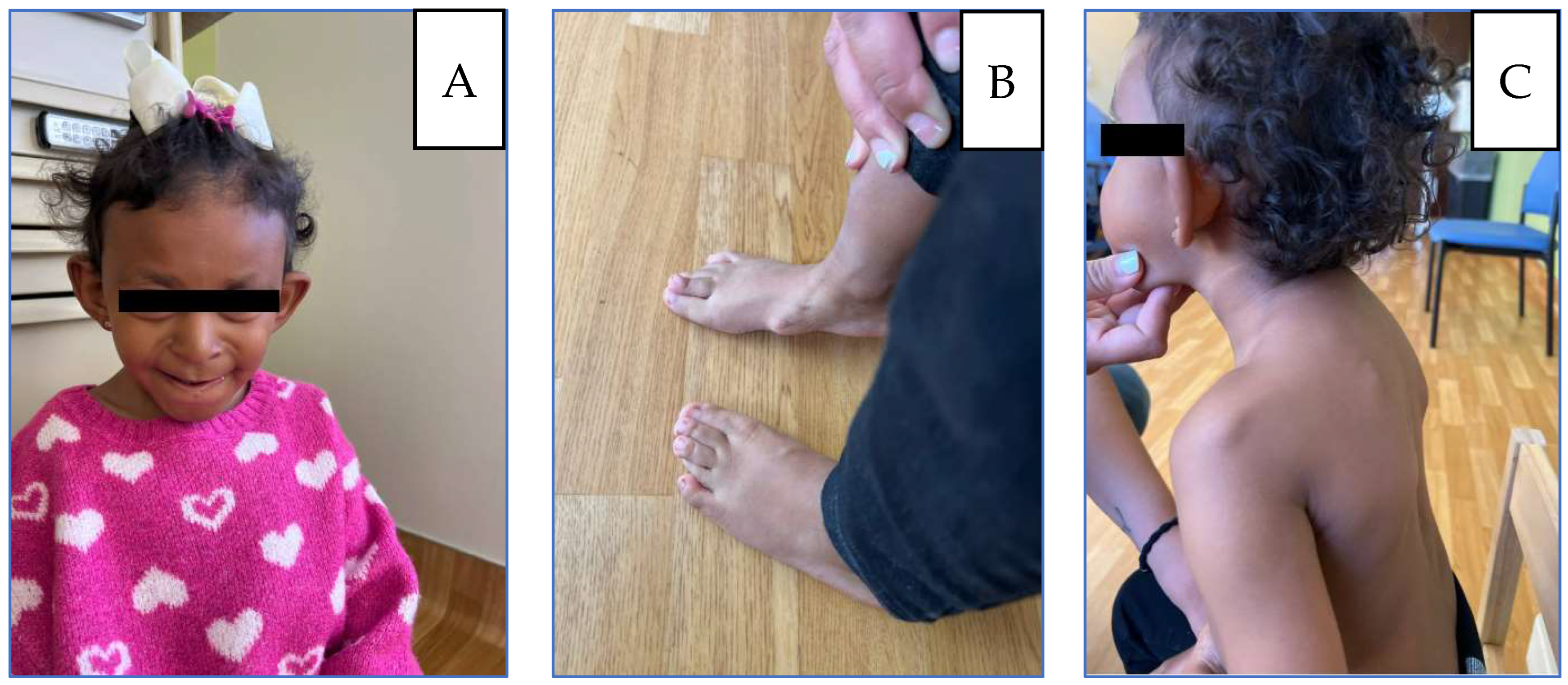 A Complex Case of Langer–Giedion Syndrome, Cornelia de Lange Syndrome ...