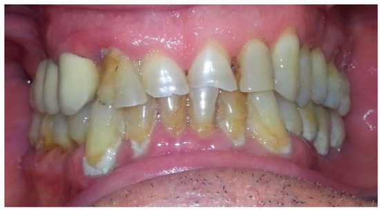 Pilot Study of Use of Nitric Oxide in Monitoring Multiple Dental Foci ...
