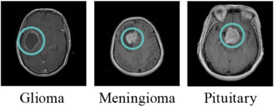 A Novel MRI Diagnosis Method for Brain Tumor Classification Based on ...