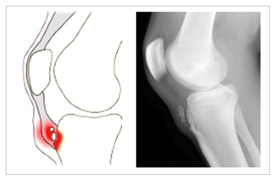 Osgood-Schlatter Disease: Appearance, Diagnosis and Treatment: A ...