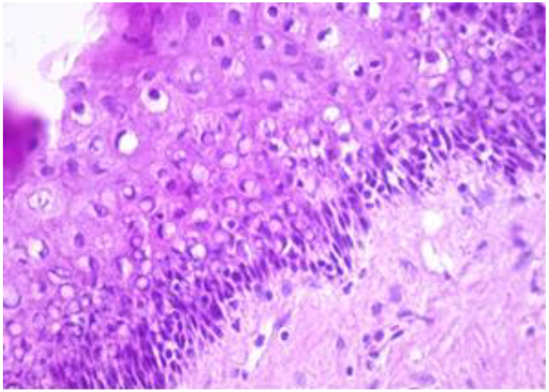 Healthcare Free Full Text Epidermoid Cyst Of The Uterine Cervix An Healthcare Free Full Text Epidermoid Cyst Of The Uterine Cervix An