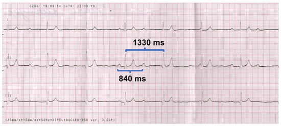 Congenital Complete Heart Block—To Stimulate (When?) or Not to Stimulate?
