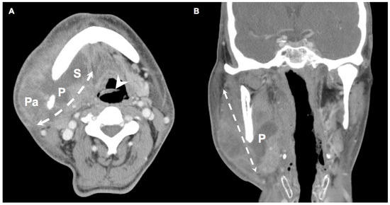 Sequential Impact of Diabetes Mellitus on Deep Neck Infections ...