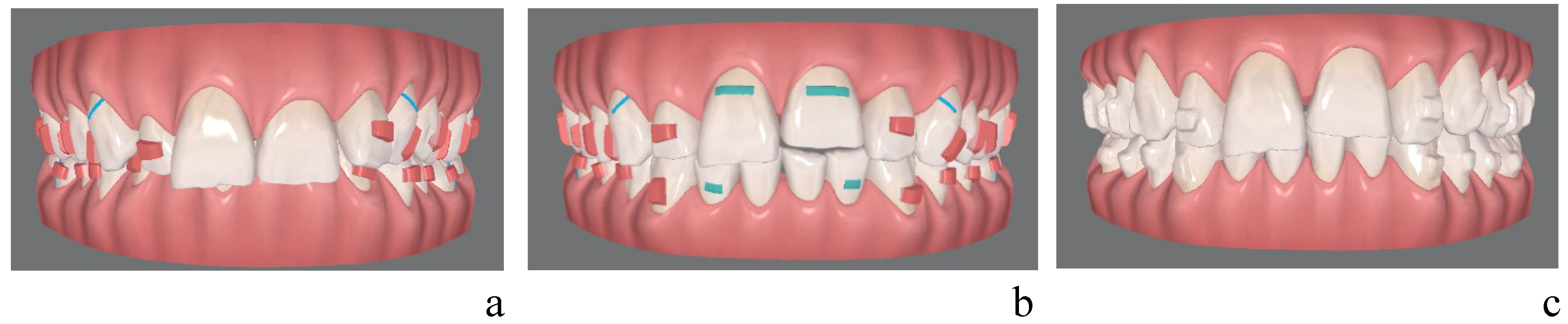 Predictability of Deep Bite Correction and Curve of Spee Flattening in ...