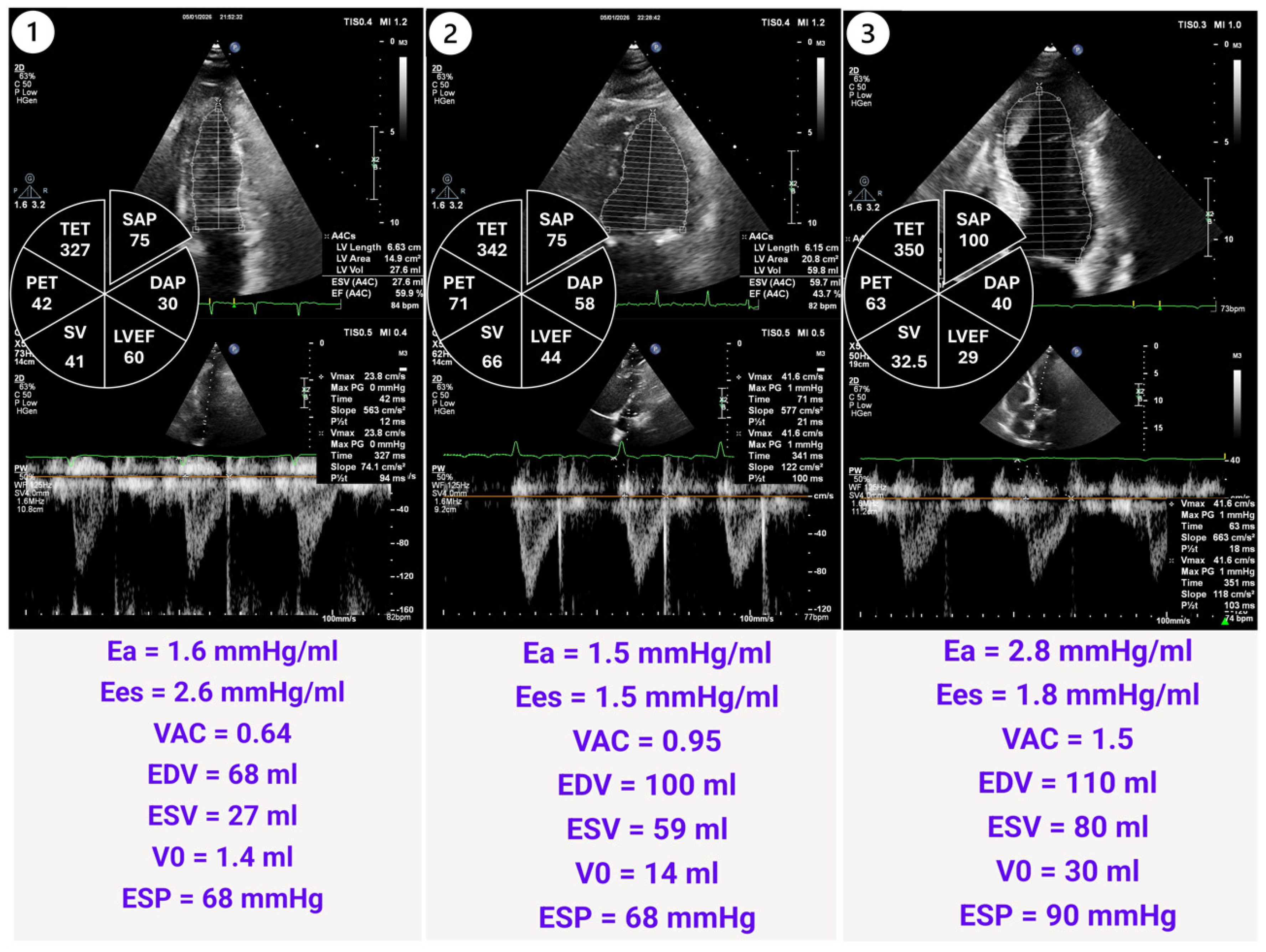 Why and How to Measure Left Ventriculo-Arterial Coupling in Rapidly ...