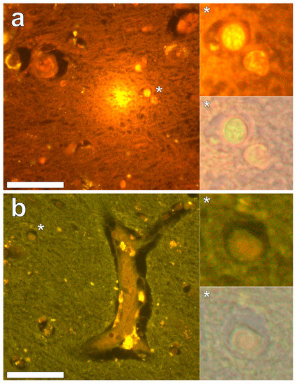 Aluminium in Brain Tissue in Epilepsy: A Case Report from Camelford