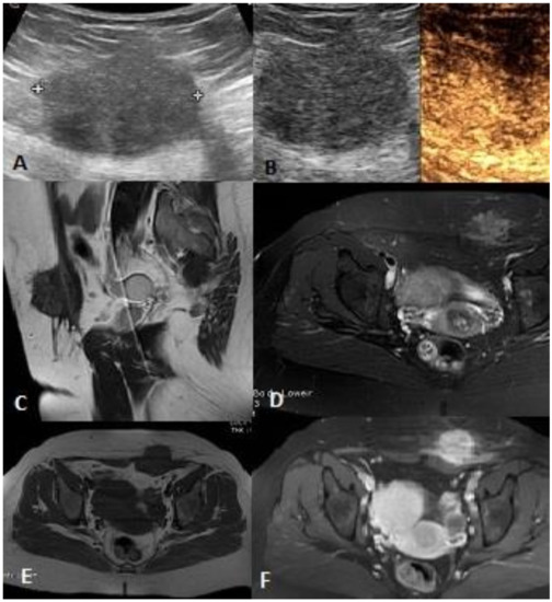Small Subcutaneous Soft Tissue Tumors