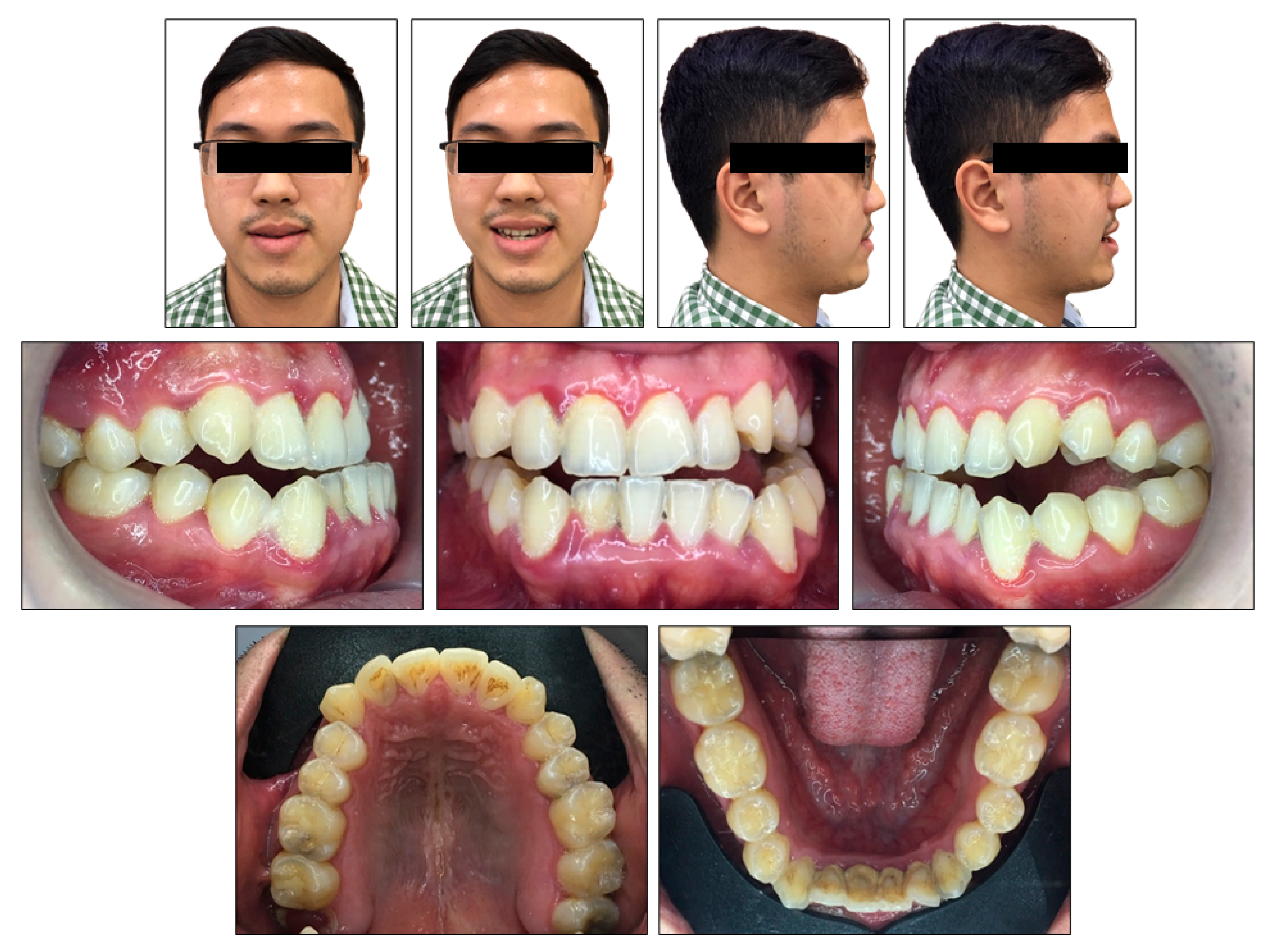 Class 3 Malocclusion Class 3 Malocclusion
