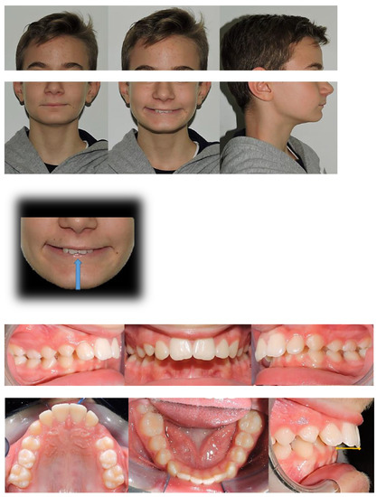 Analysis of the Changes in Occlusal Plane Inclination in a Class II ...