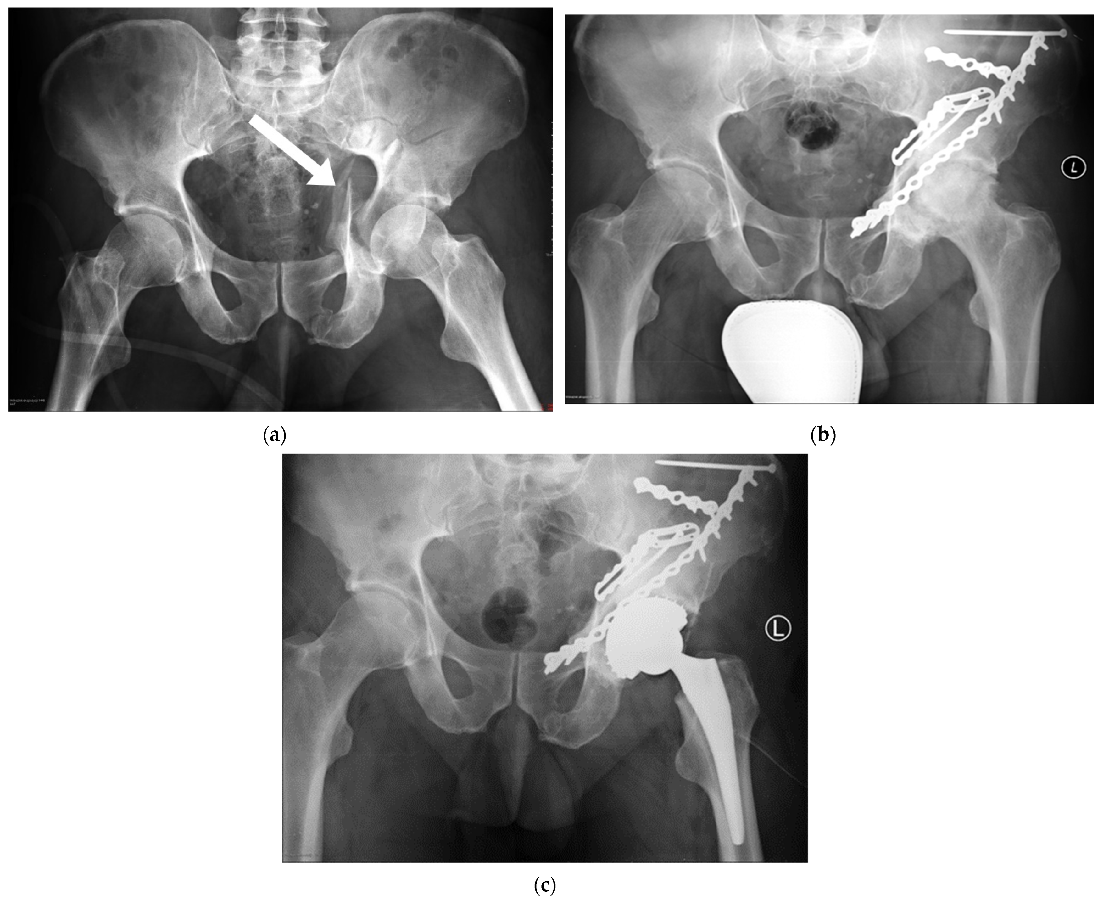 Open Reduction Internal Fixation Hip Open Reduction Internal Fixation Hip