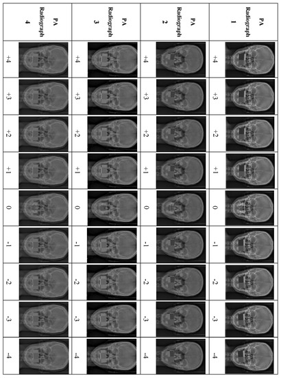 Criterion Validity of the Newly Developed Occlusal Cant Index