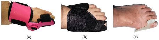 The Evaluation of Orthotics in Reducing Hallux Valgus Angle in Patients ...
