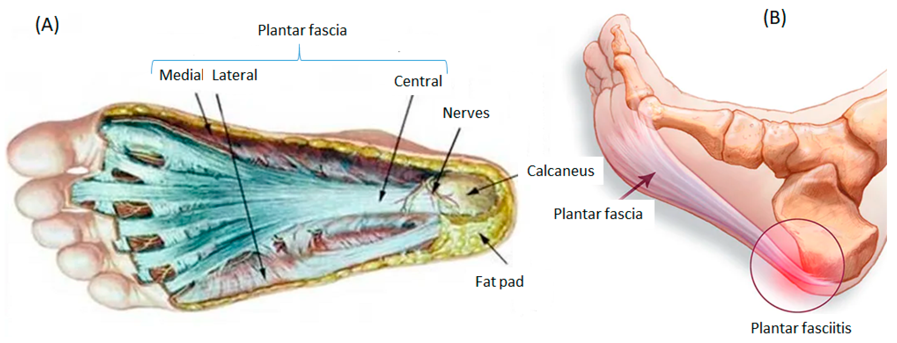 Plantar Fasciitis In Soccer Players A Systemic Review Plantar Fasciitis In Soccer Players A Systemic Review