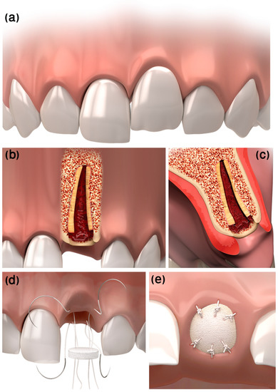Flapless Decoronation: A Minimally Invasive Approach