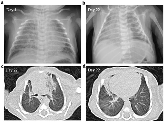 Vertical Transmission of Coxsackievirus A6 with Severe Congenital ...
