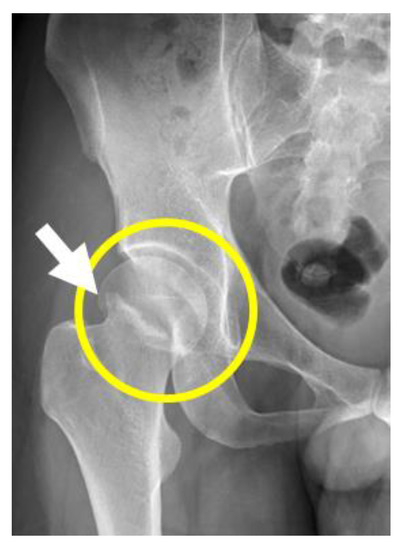 Management for A Depressive Patient with Femoral Neck Fracture by ...