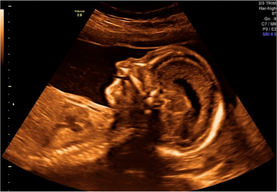 Contribution of a Novel B3GLCT Variant to Peters Plus Syndrome ...