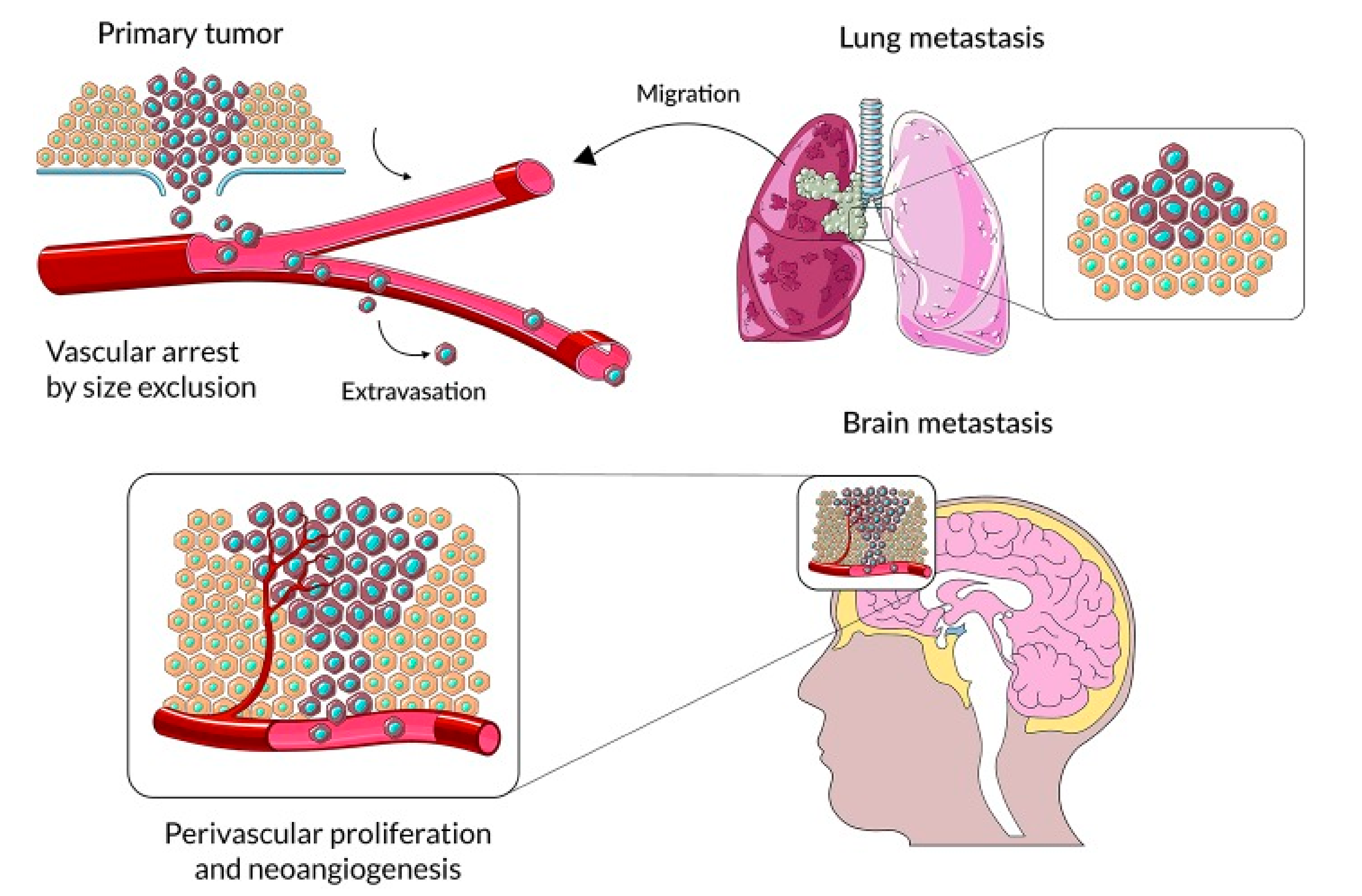 IJMS Free Full Text Treatment Of Brain Metastases Of Non Small Cell IJMS Free Full Text Treatment Of Brain Metastases Of Non Small Cell