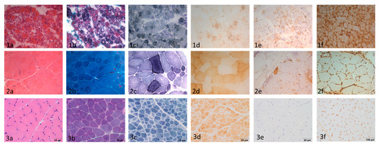 Pathological Features in Paediatric Patients with TK2 Deficiency