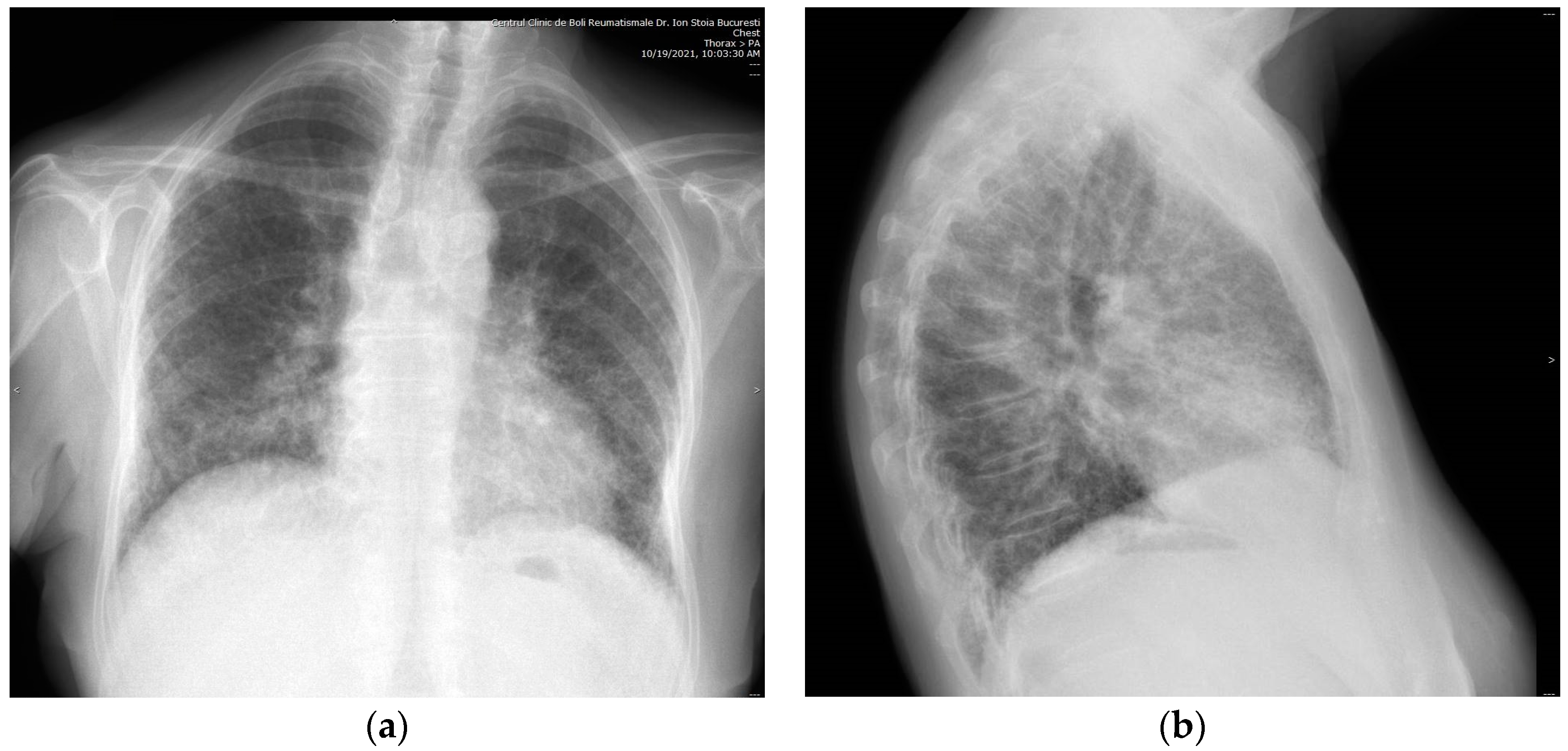 IJMS Free Full Text Lung Damage In Rheumatoid Arthritis A IJMS Free Full Text Lung Damage In Rheumatoid Arthritis A