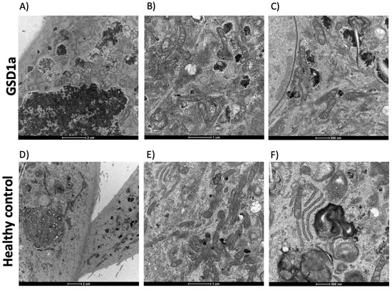 Urine-Derived Epithelial Cells as a New Model to Study Renal Metabolic ...