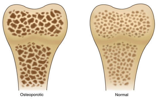 Osteoporosis: Molecular Pathology, Diagnostics, and Therapeutics