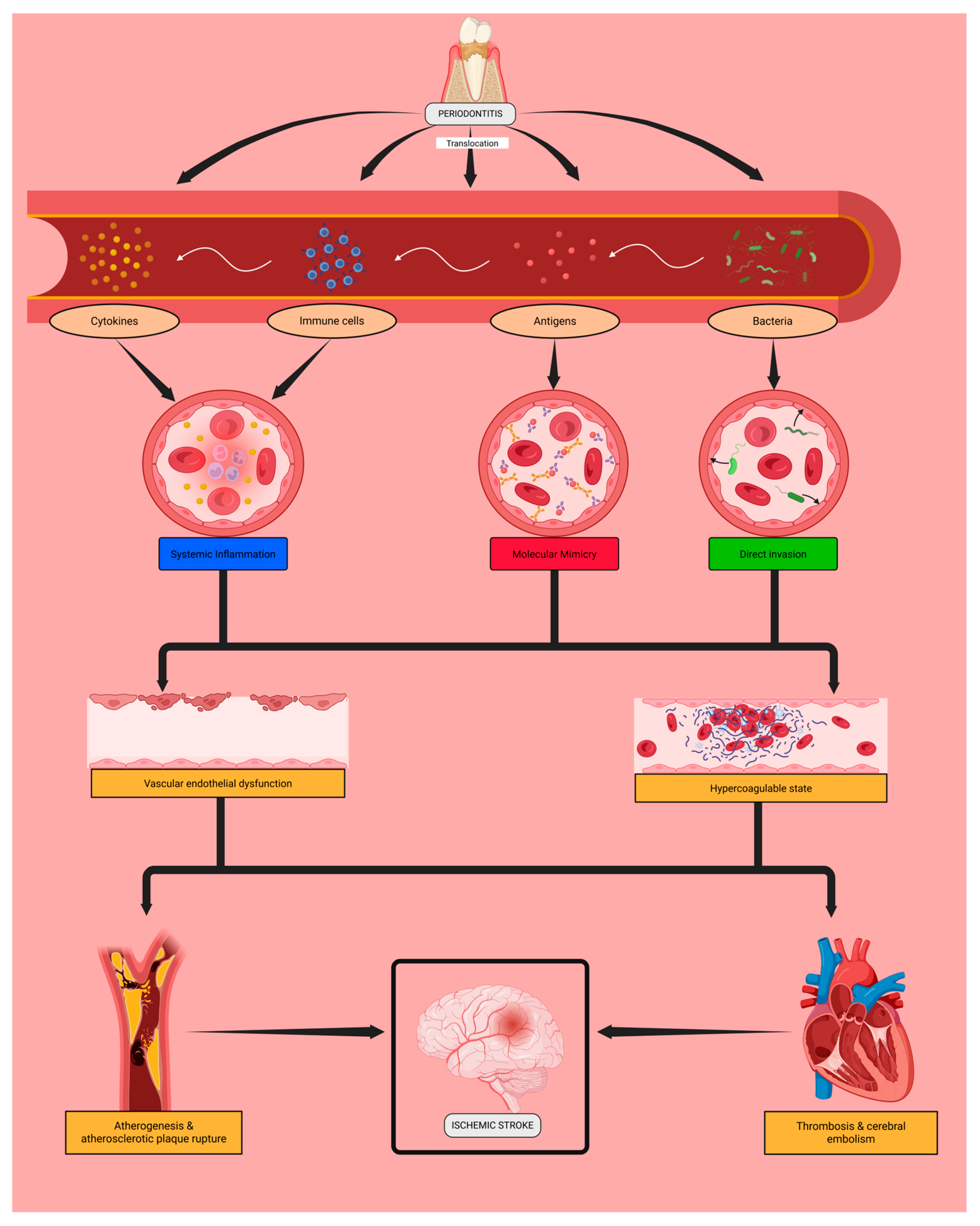 A Review on the Role of Oral Bacteria in Stroke