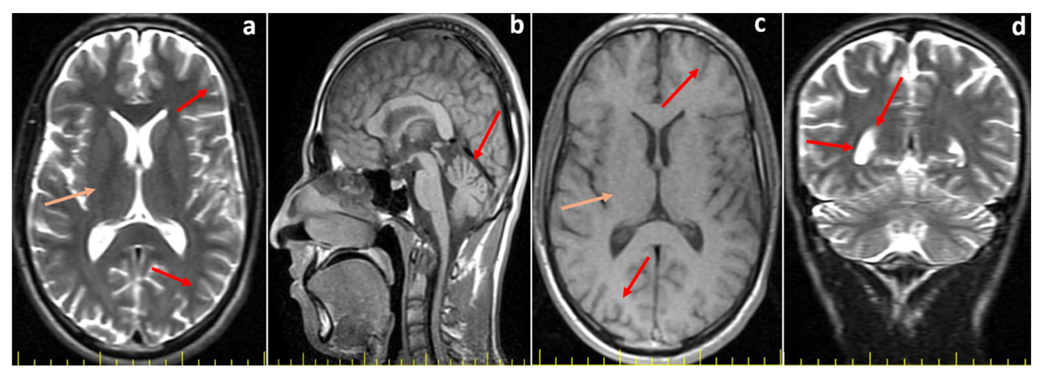 Biallelic Truncating DNAH14 Variant in Siblings with Neurodevelopmental ...