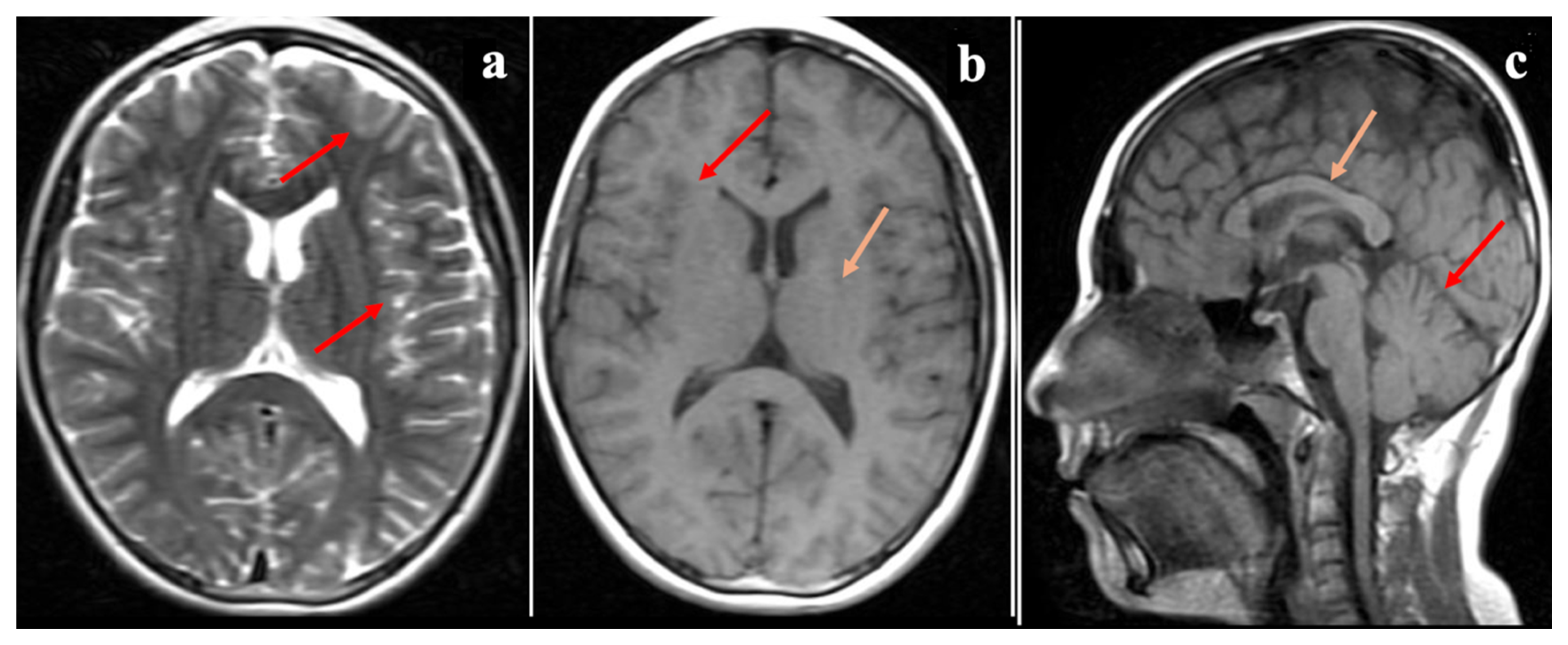 Biallelic Truncating DNAH14 Variant in Siblings with Neurodevelopmental ...