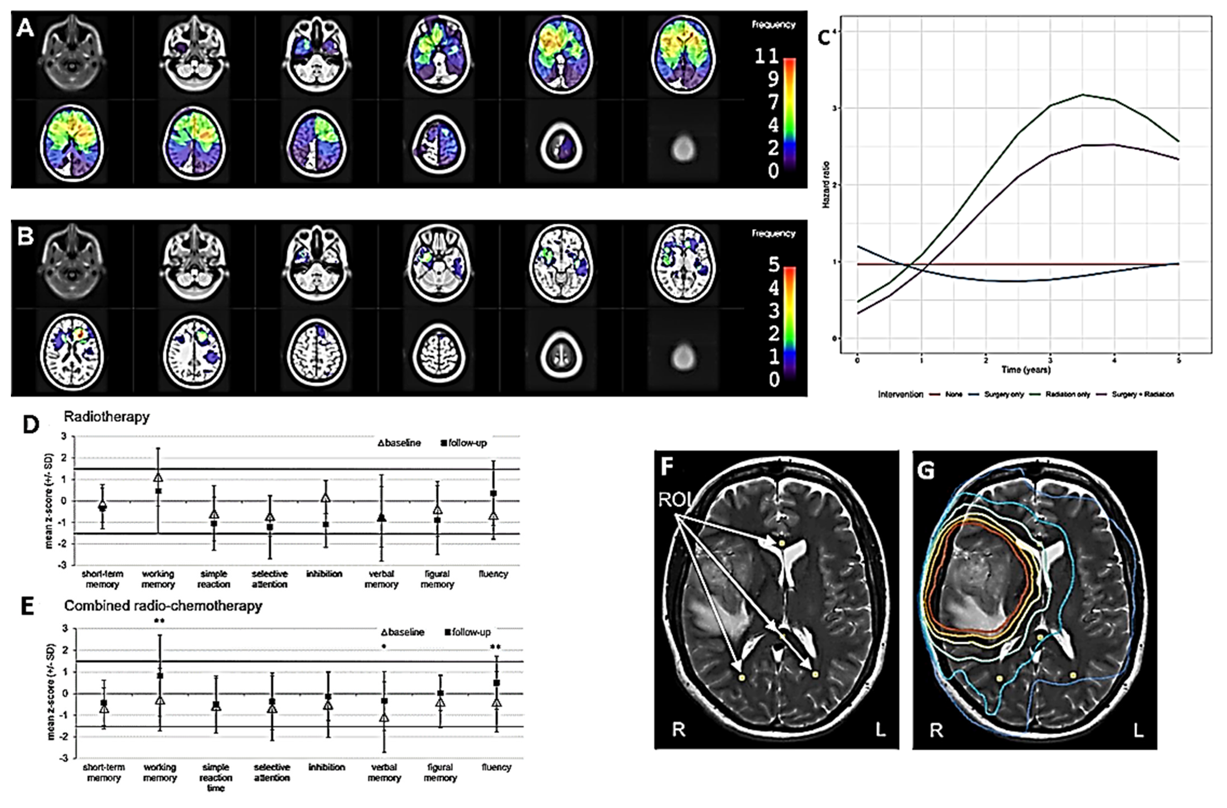 Radiotherapy for High-Grade Gliomas in Adults and Children: A ...