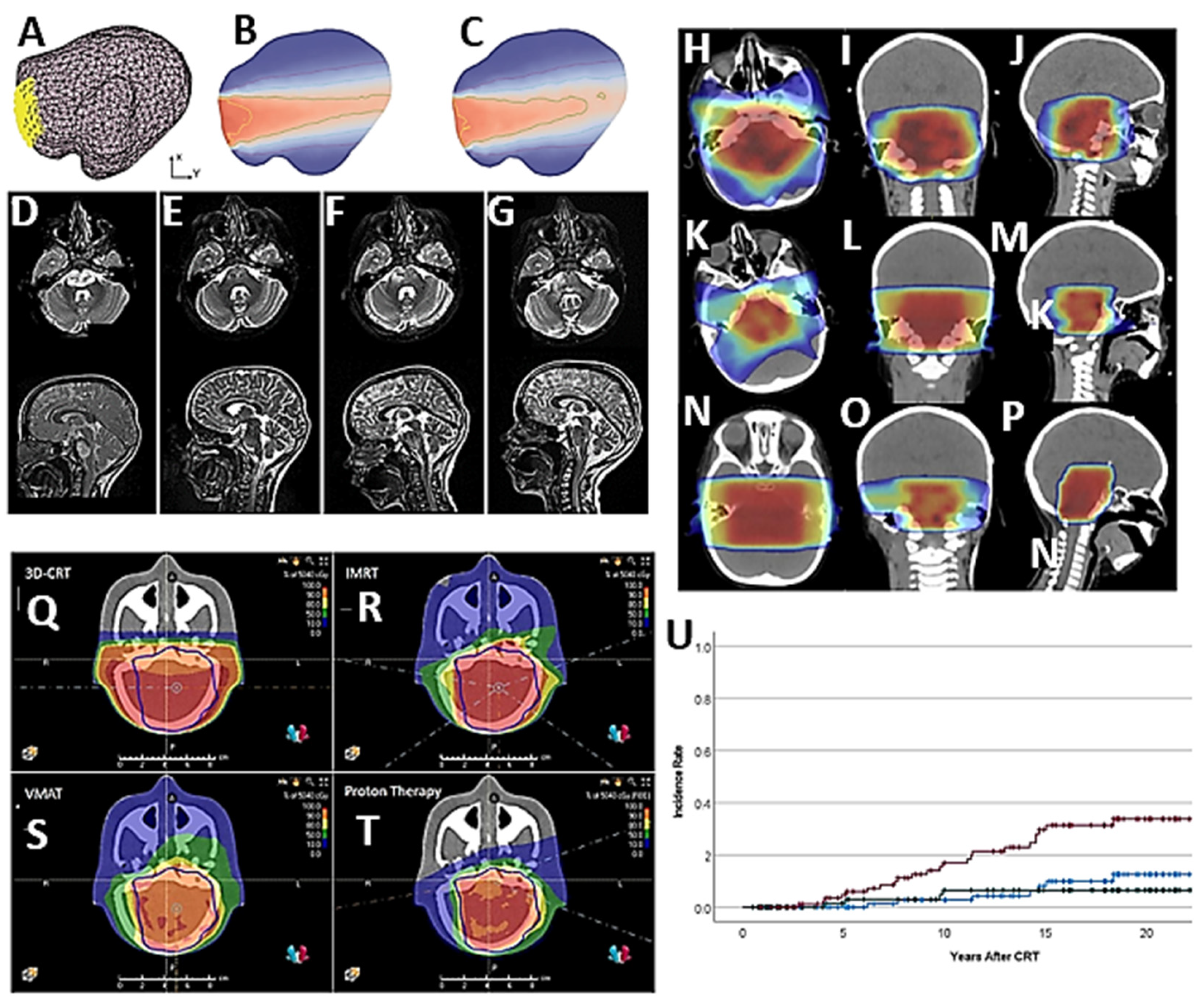 Radiotherapy for High-Grade Gliomas in Adults and Children: A ...