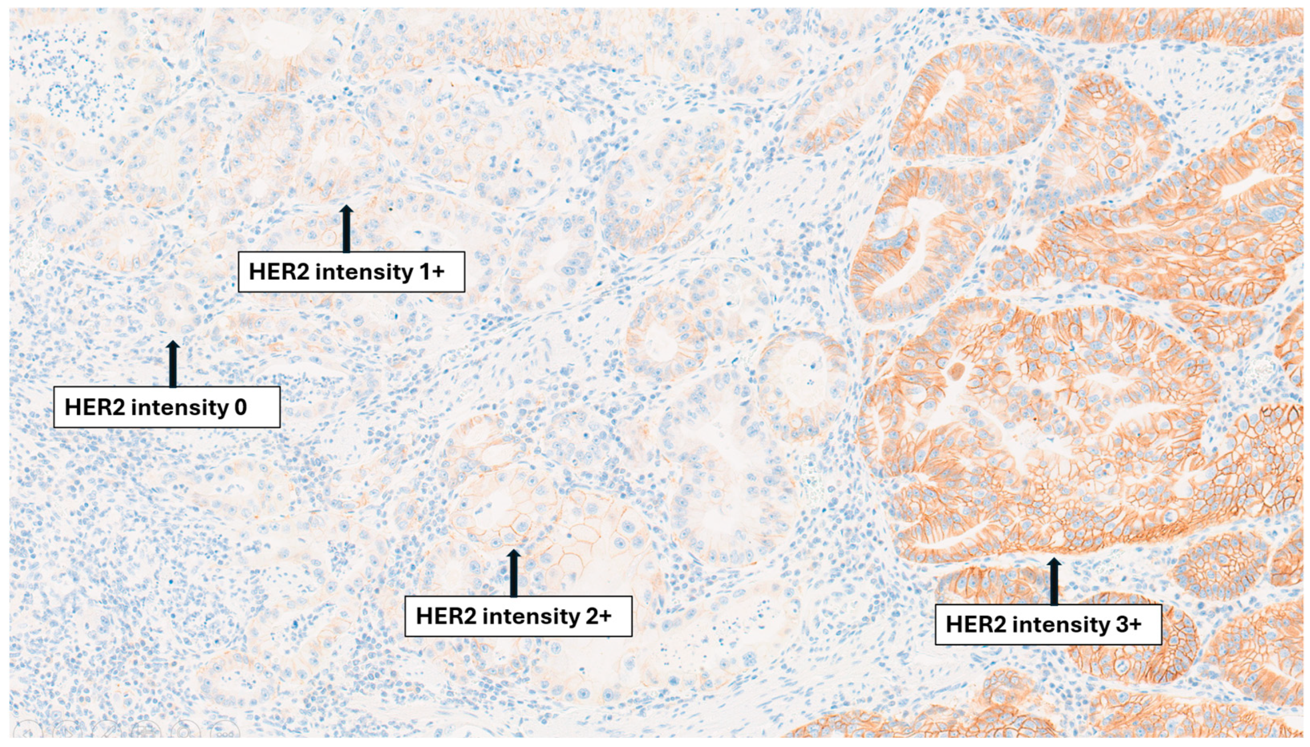 Diagnostic and Therapeutic Challenges Related to HER2 Heterogeneity in ...
