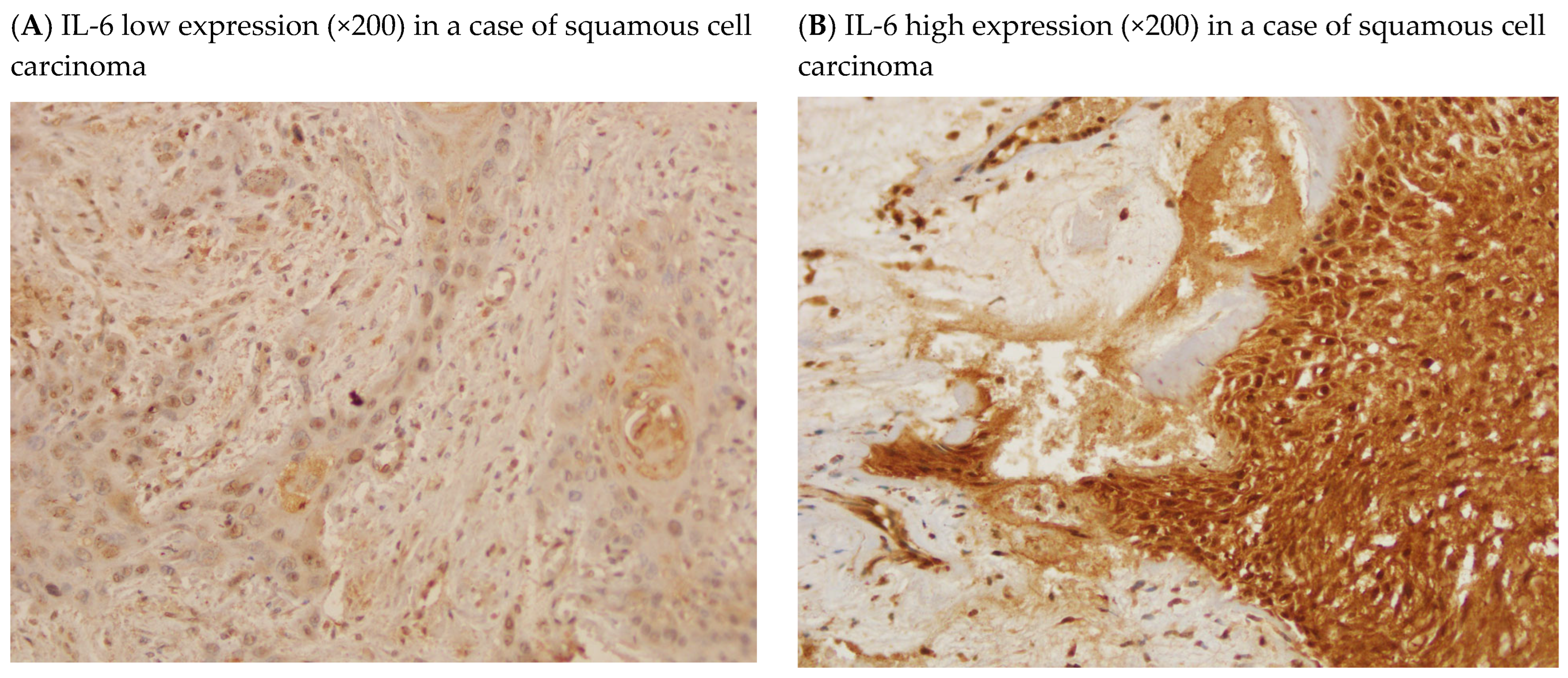 Tissue IL-6/LIF/LIFR and CXCL9 Expression Correlates with High-Risk NBI ...