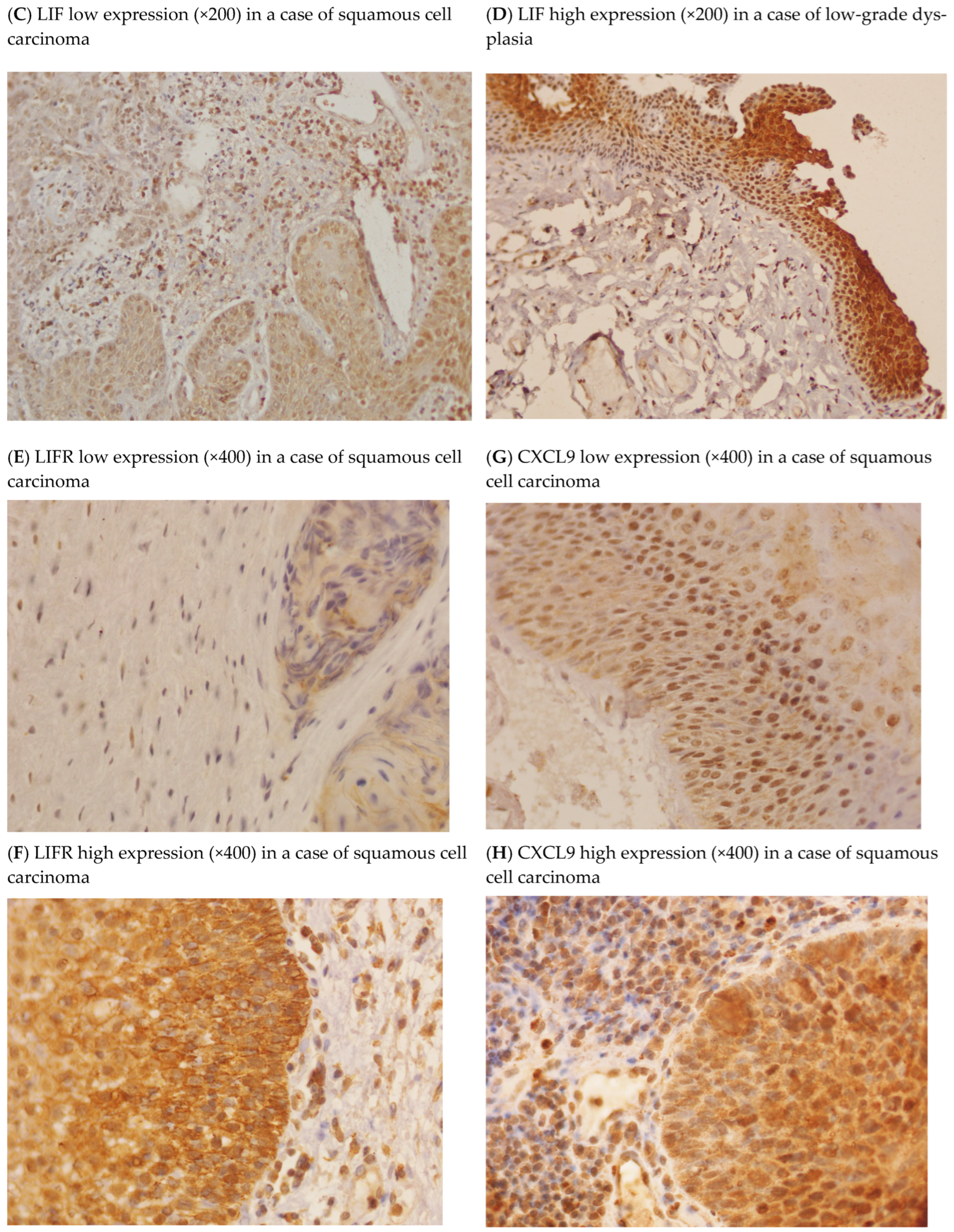 Tissue IL-6/LIF/LIFR and CXCL9 Expression Correlates with High-Risk NBI ...