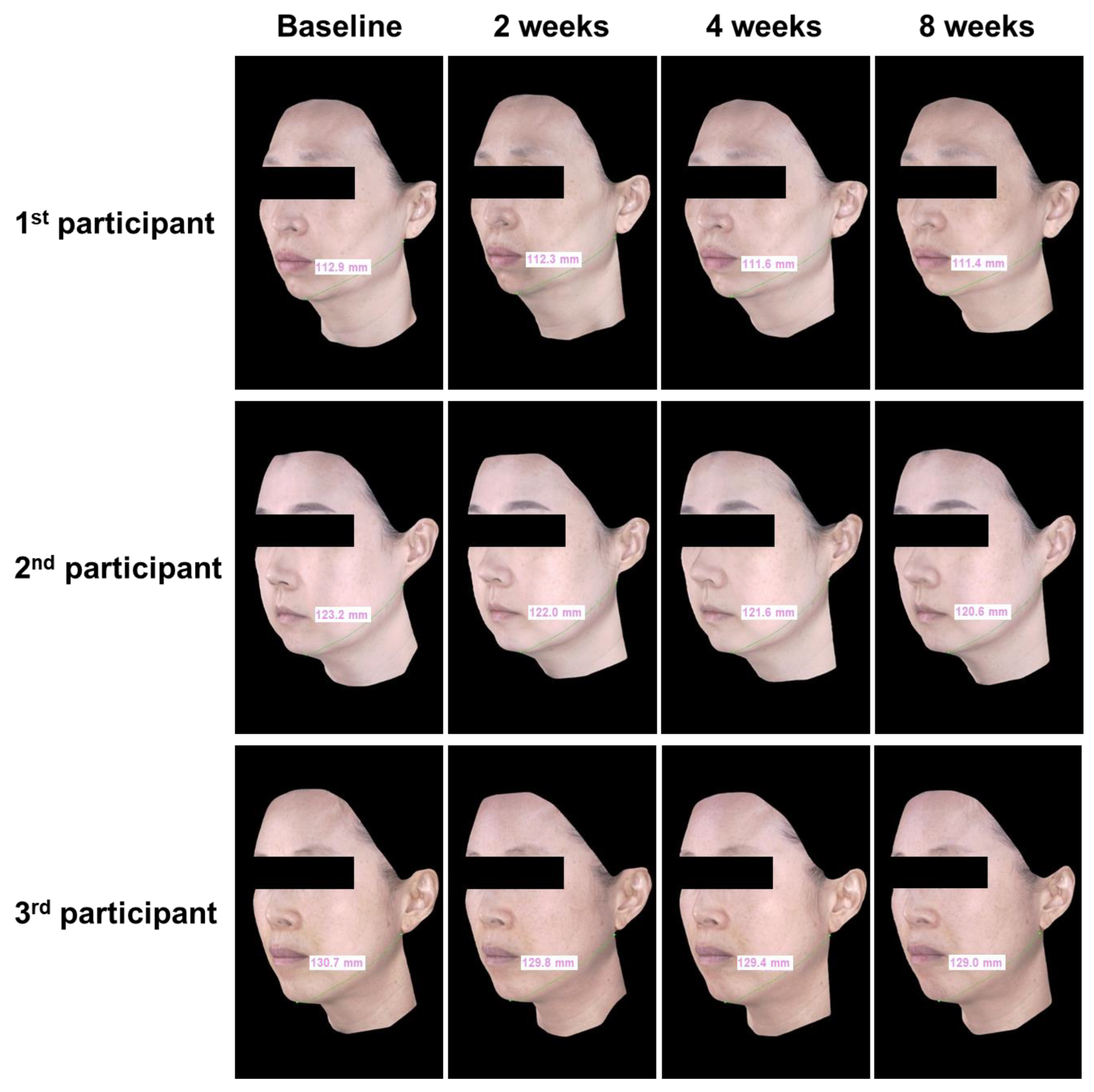 Innovative Facial Contouring Using a Monopolar Radiofrequency Device ...