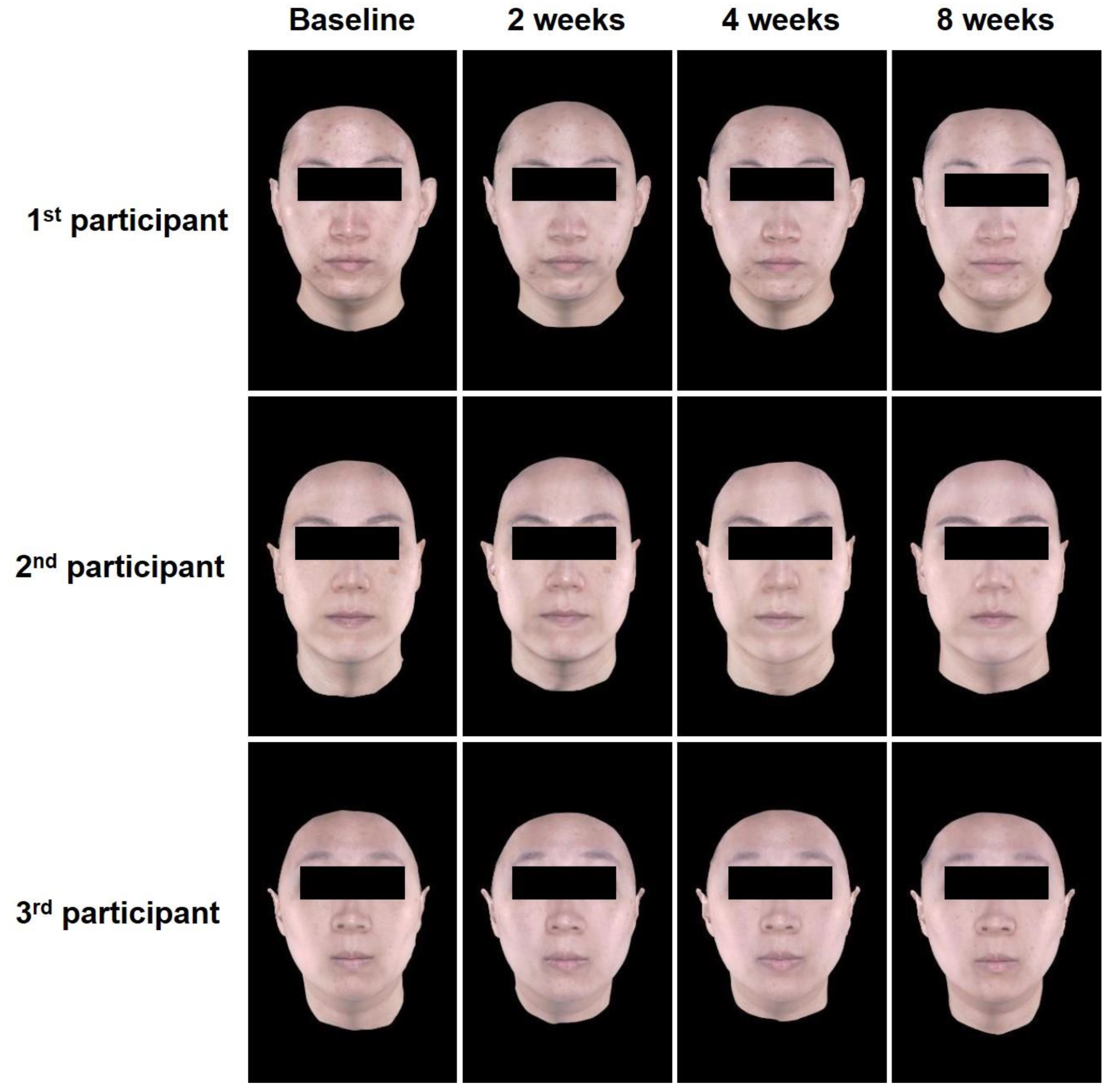 Innovative Facial Contouring Using a Monopolar Radiofrequency Device ...