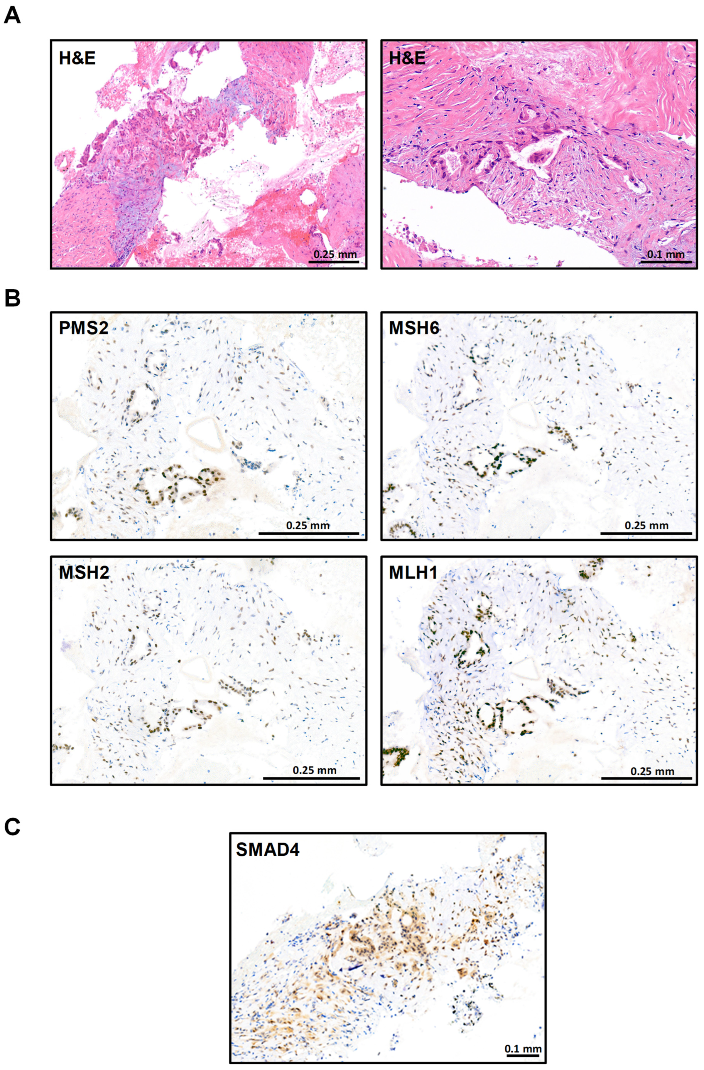 EIF3E::RSPO2 Fusion in Metastatic Pancreatic Ductal Adenocarcinoma: A ...