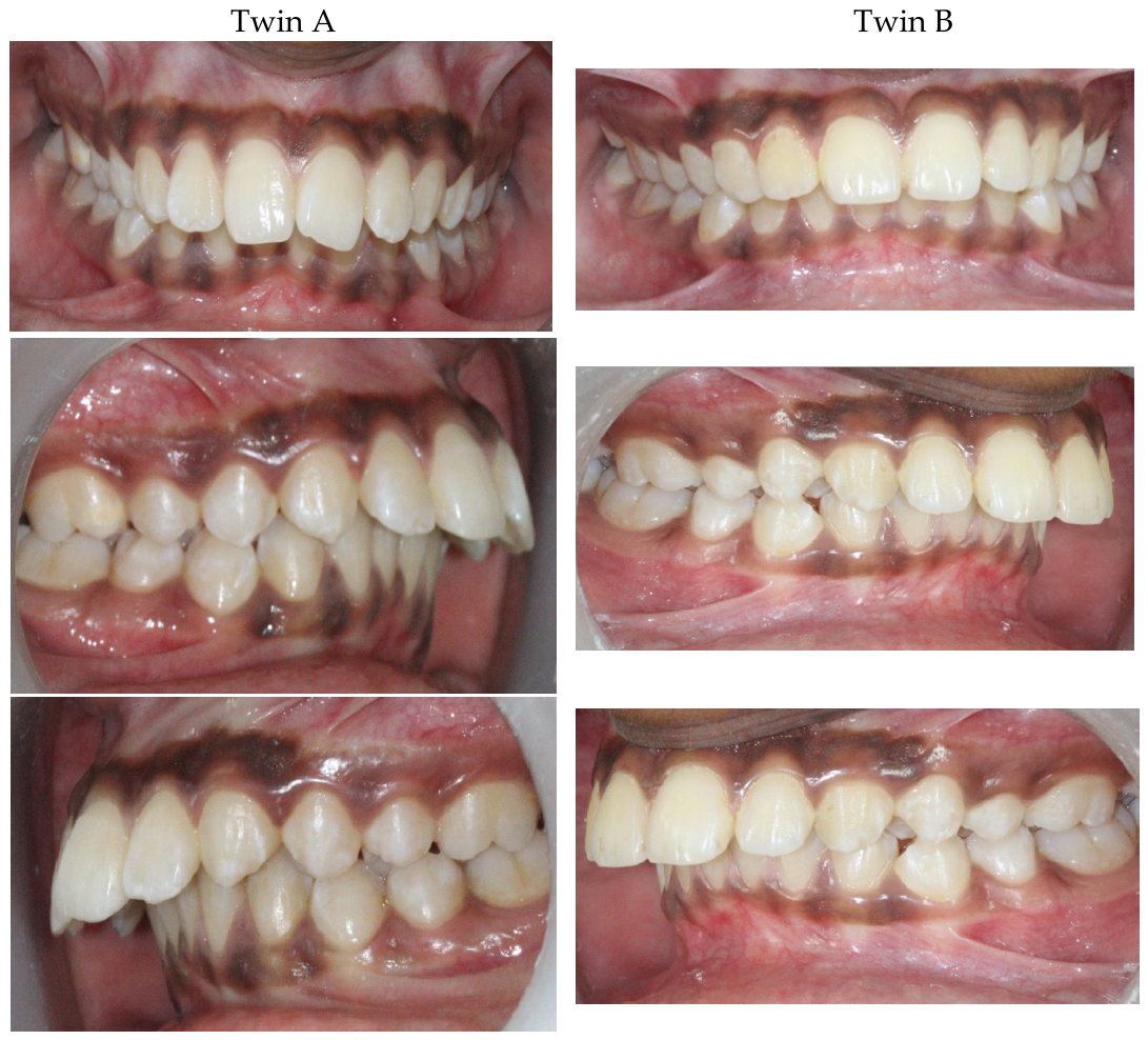 Comparative Evaluation of a Clear Functional Jaw Corrector and a ...