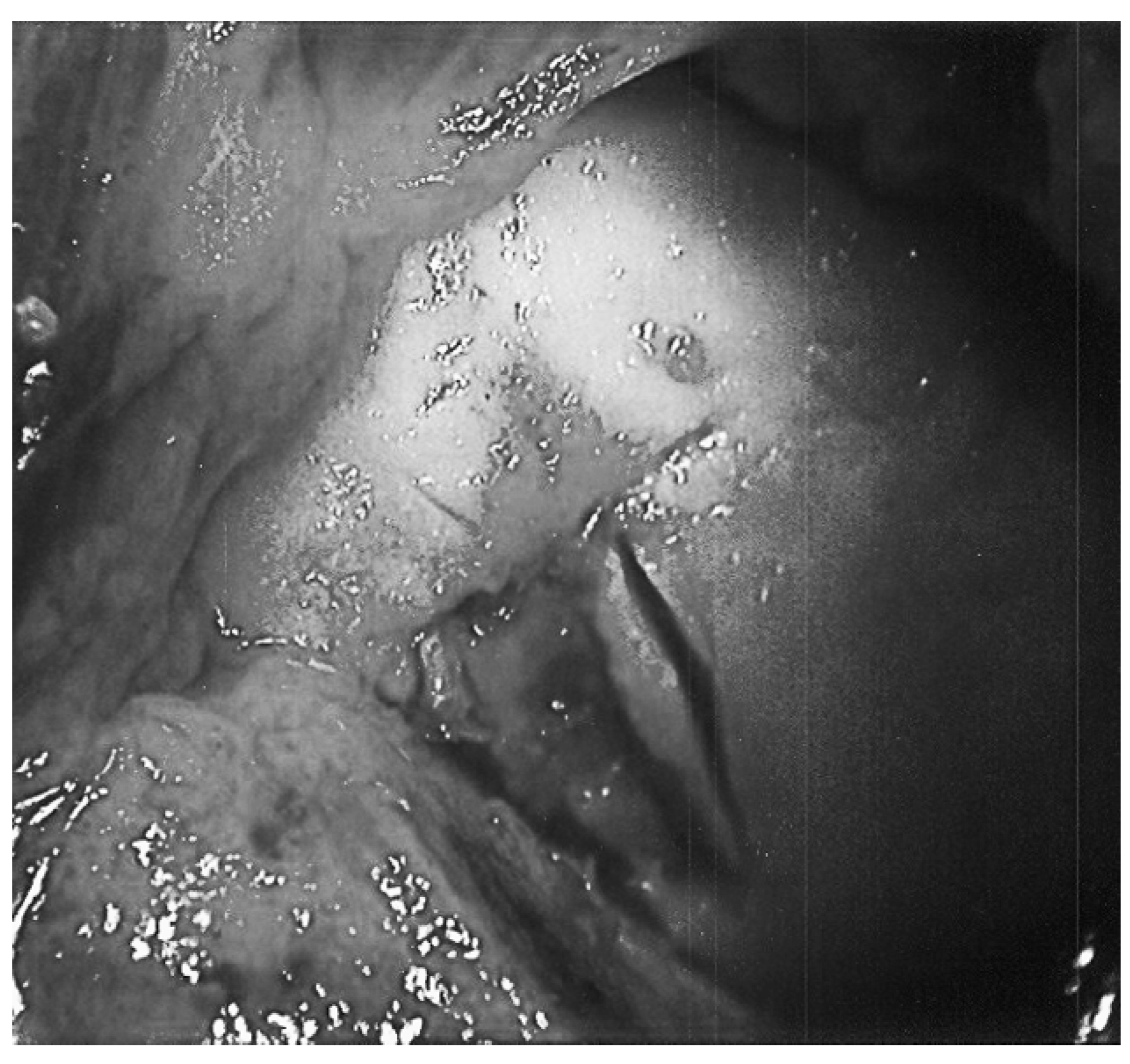 Central Talar Dome Lesions