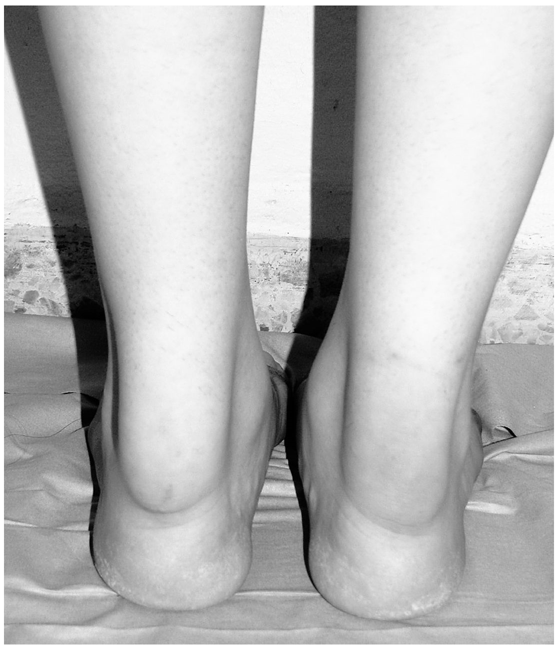 Cerebrotendinous Xanthomatosis Presenting with Bilateral Achilles ...