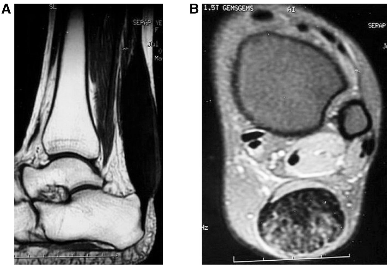 Cerebrotendinous Xanthomatosis Presenting with Bilateral Achilles ...