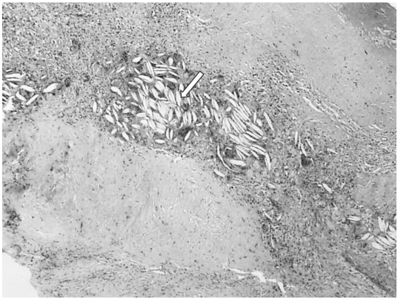 Cerebrotendinous Xanthomatosis Presenting with Bilateral Achilles ...