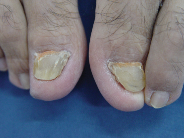 Complications of Sodium Hydroxide Chemical Matrixectomy. Nail Dystrophy ...