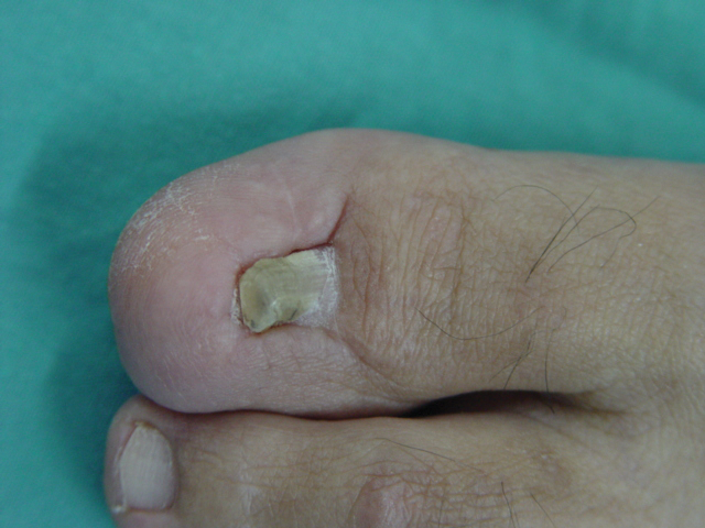 Complications of Sodium Hydroxide Chemical Matrixectomy. Nail Dystrophy ...
