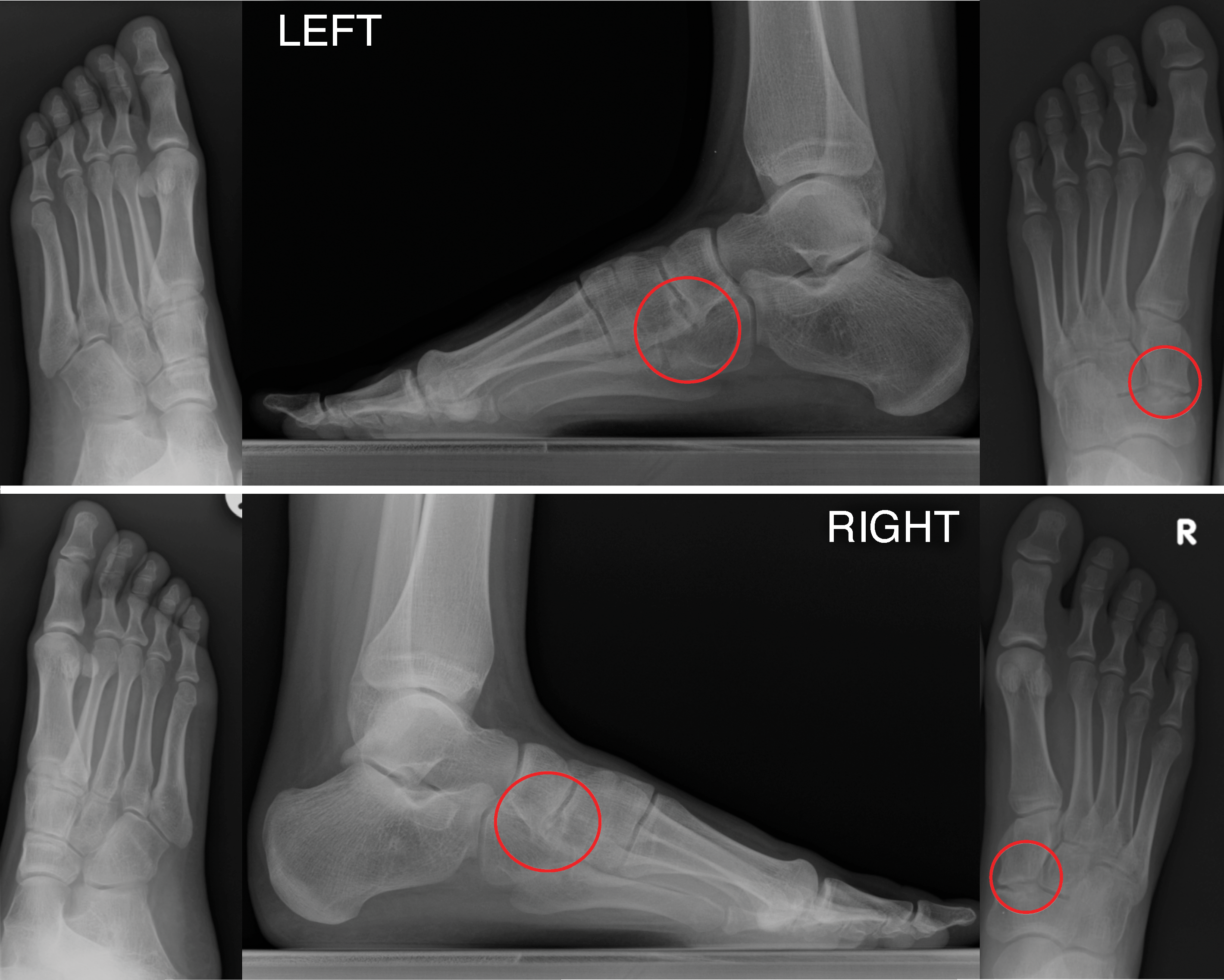 A Rare Presentation of Foot Pain. Bilateral Navicular–Medial Cuneiform ...