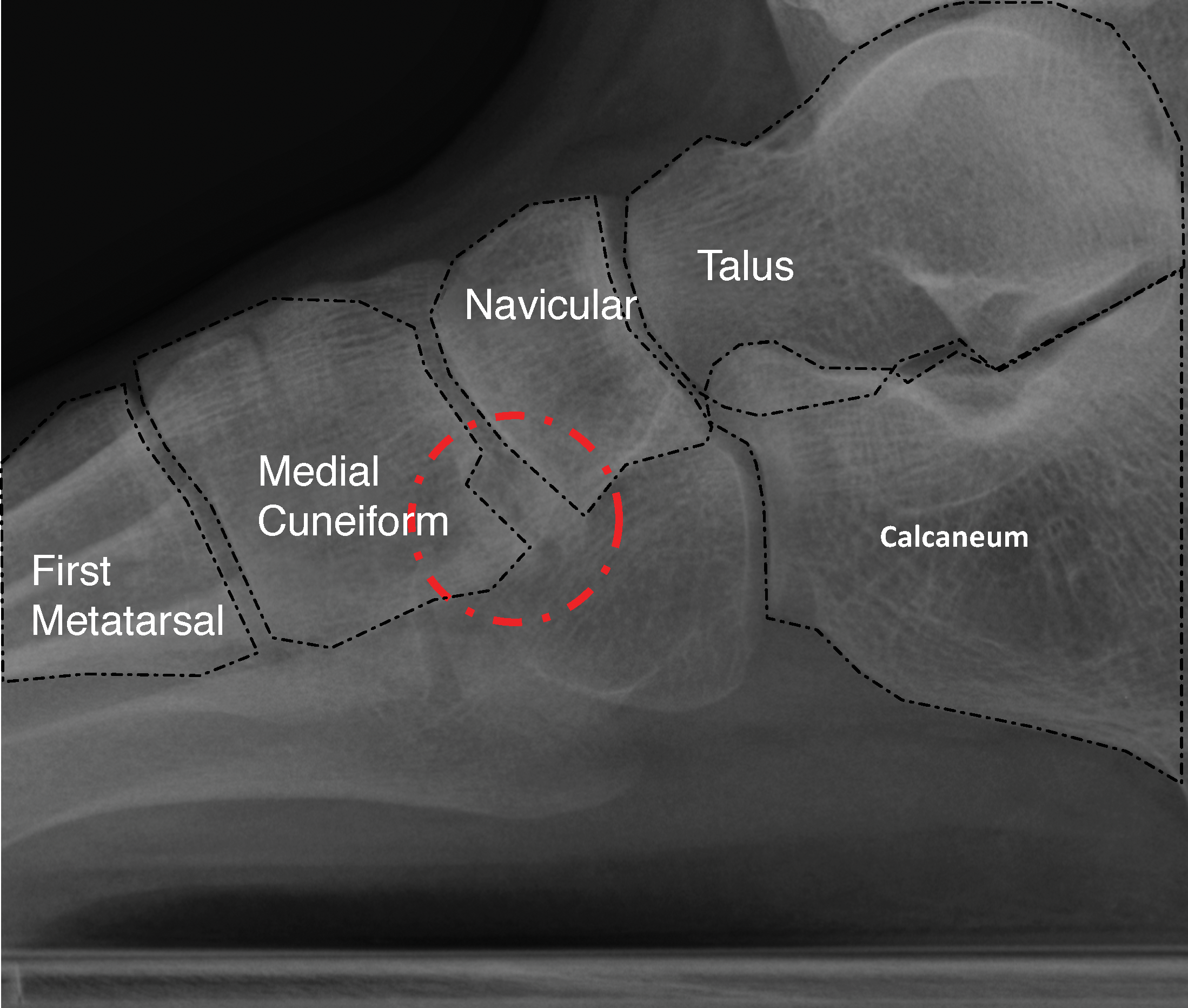 A Rare Presentation of Foot Pain. Bilateral Navicular–Medial Cuneiform ...